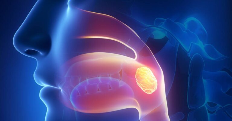Angína: Nejčastější Příčina Bolesti Mandlí [Příznaky & Léčba]